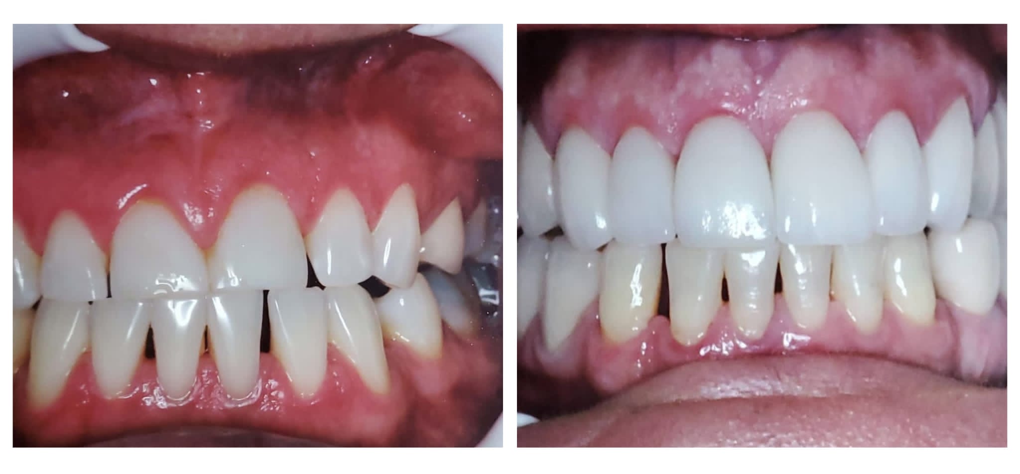 Before And After - Dr. George Harouni